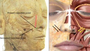 Clinical Application of Neuromodulators: Lower Face/Neck - Rejuvenation ...