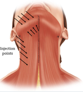 Clinical Application of Neuromodulators: Lower Face/Neck - Rejuvenation ...