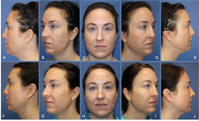 Rejuvenation of the Midface - Rejuvenation Resource