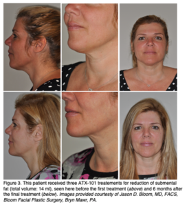 Deoxycholic Acid for Submental Fat - Rejuvenation Resource