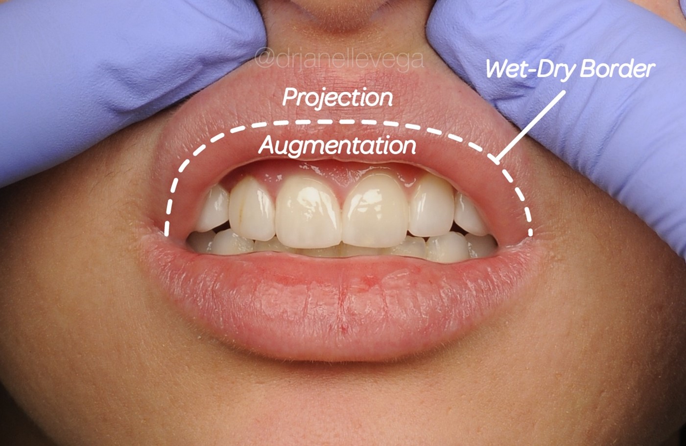 Non-surgical Rejuvenation of the Lips and Perioral Area - Rejuvenation ...