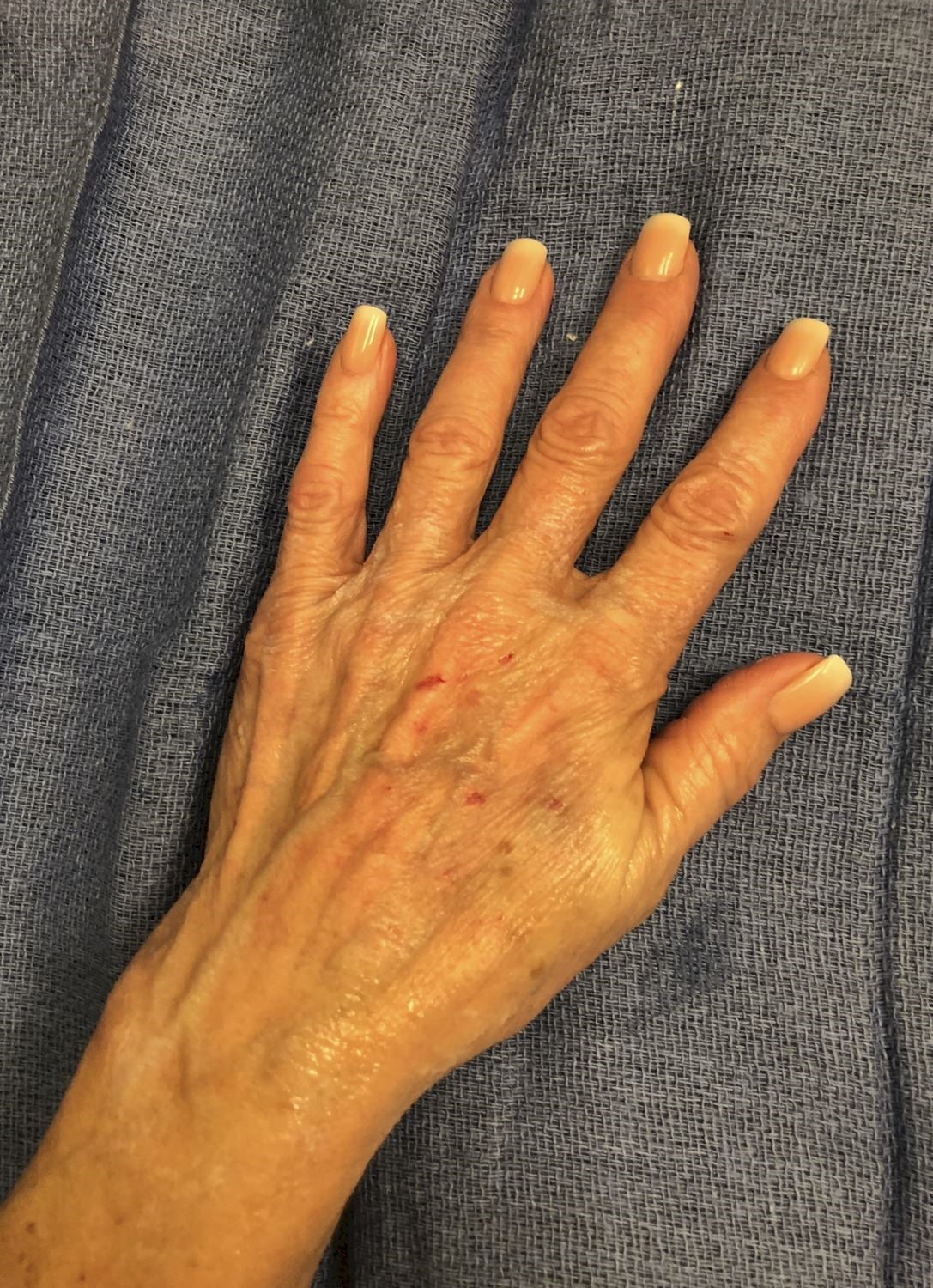 Non-Surgical Rejuvenation of Hands - Rejuvenation Resource